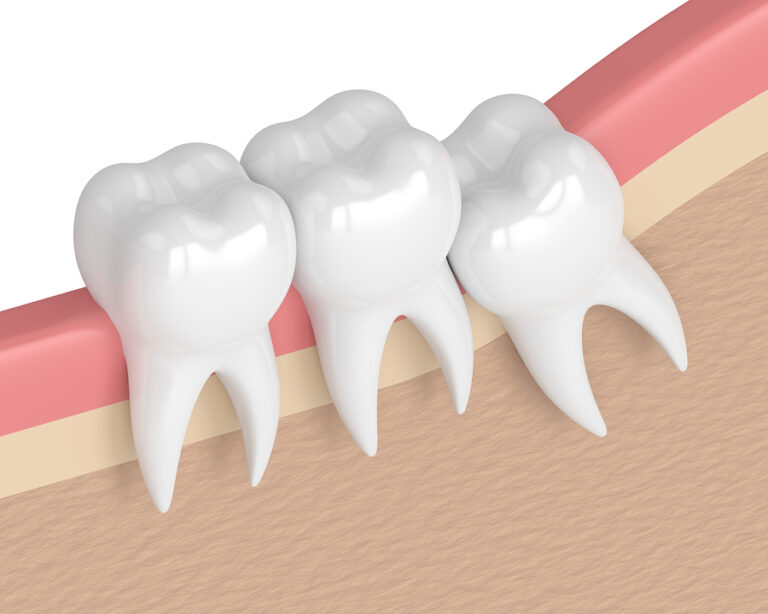 Fort Worth Oral Surgeon | Problems with Impacted Wisdom Teeth